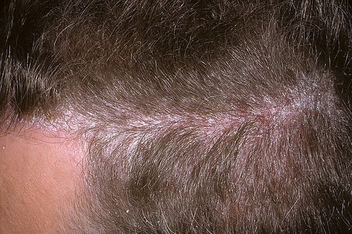 Psoriasis On The Head Photo How To Treat The Disease On The Scalp Official Site Dr Derm